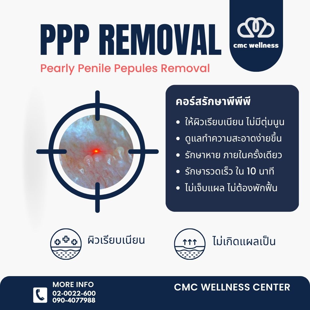 รักษาผื่นนูนพีพีพี PPP Removal (Pearly Penile Papules) - cmcwellbeing