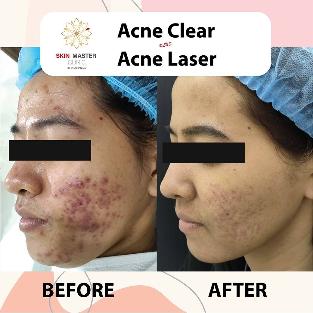 Acne clear - skinmaster-clinic