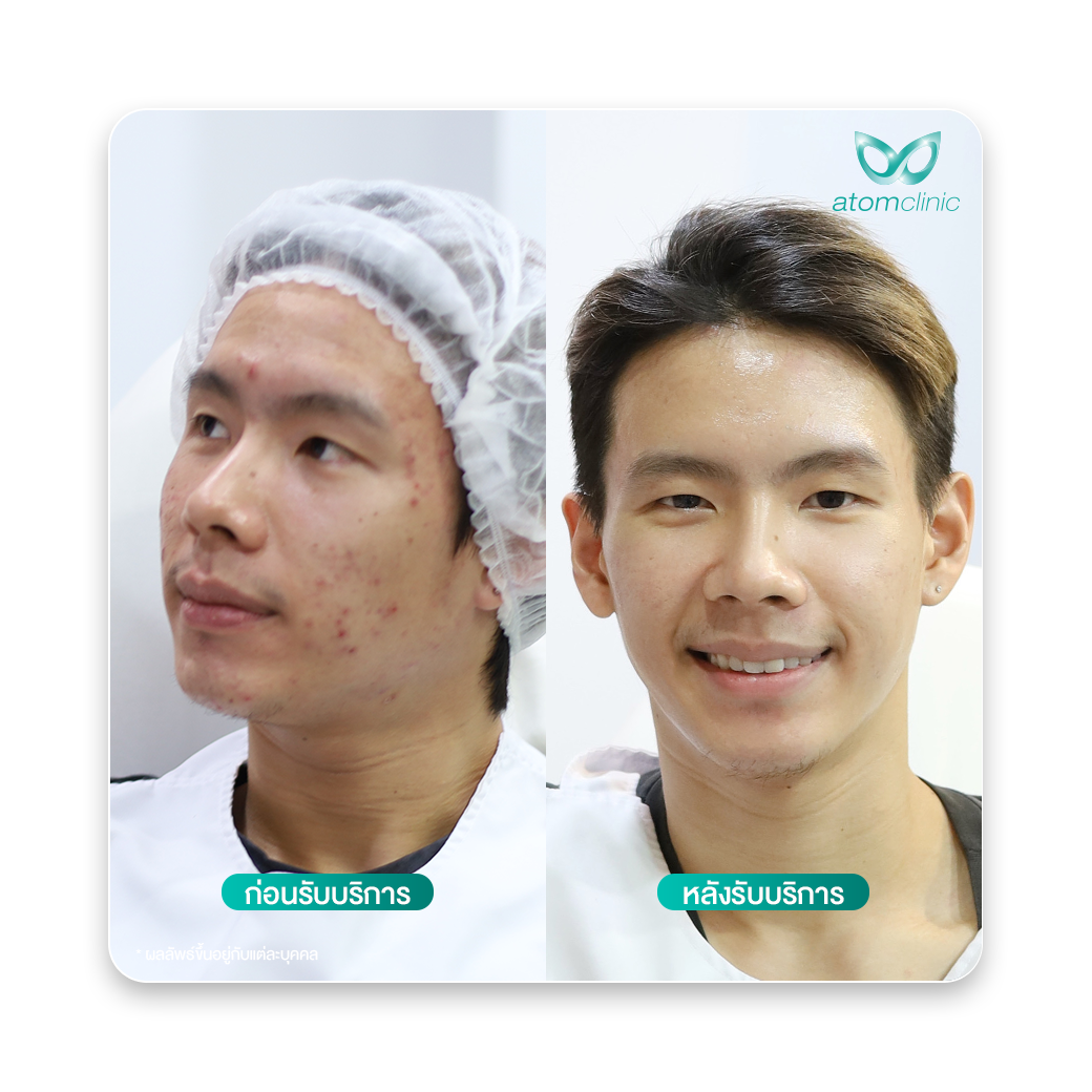 Meso Collagen เมโสคอลลาเจน - atomclinicofficial