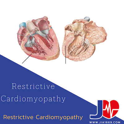 Restrictive Cardiomyopathy - jia1669