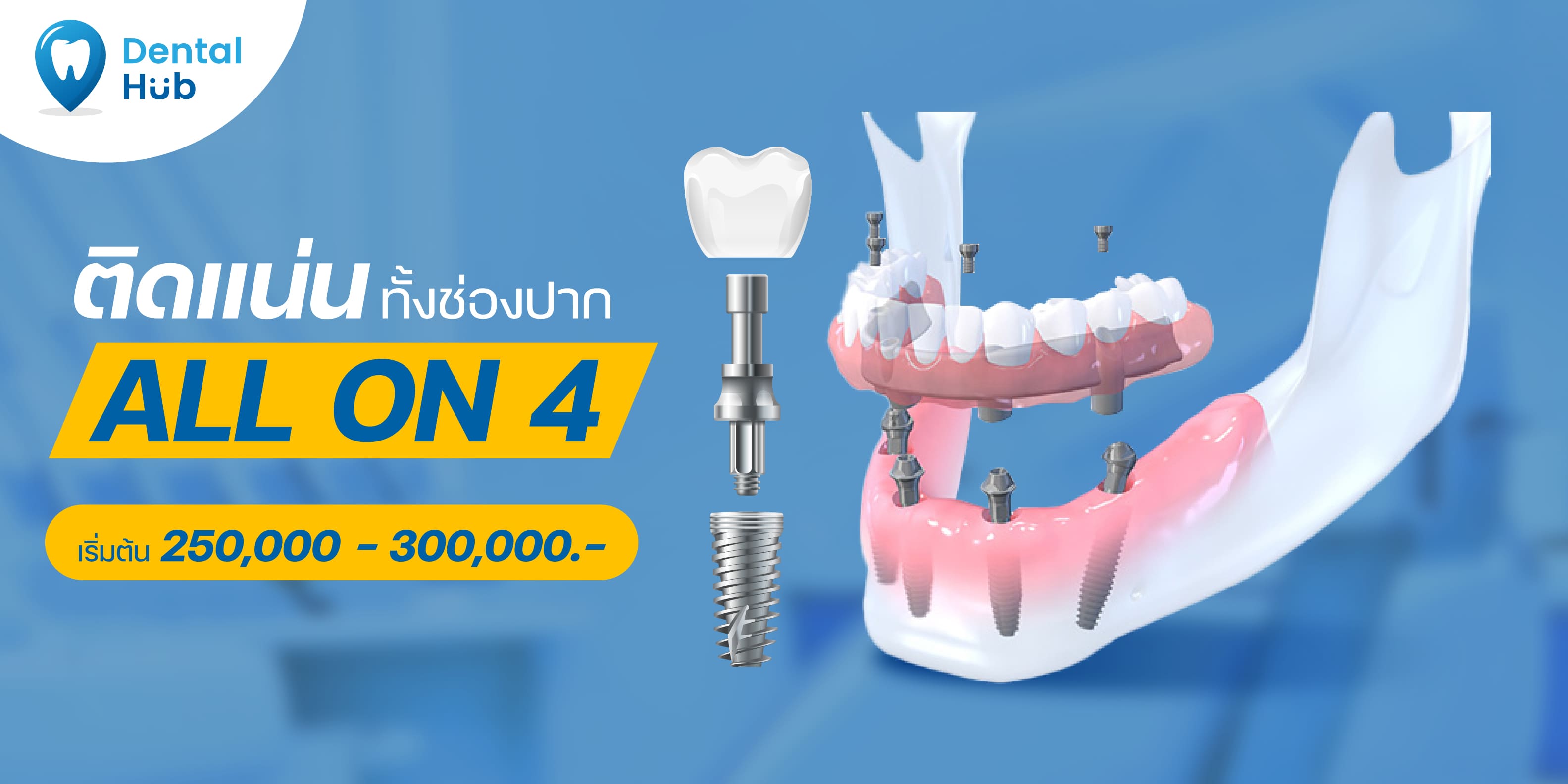รากฟันเทียมทั้งปากแบบ All on 4 - dentalhubclinic
