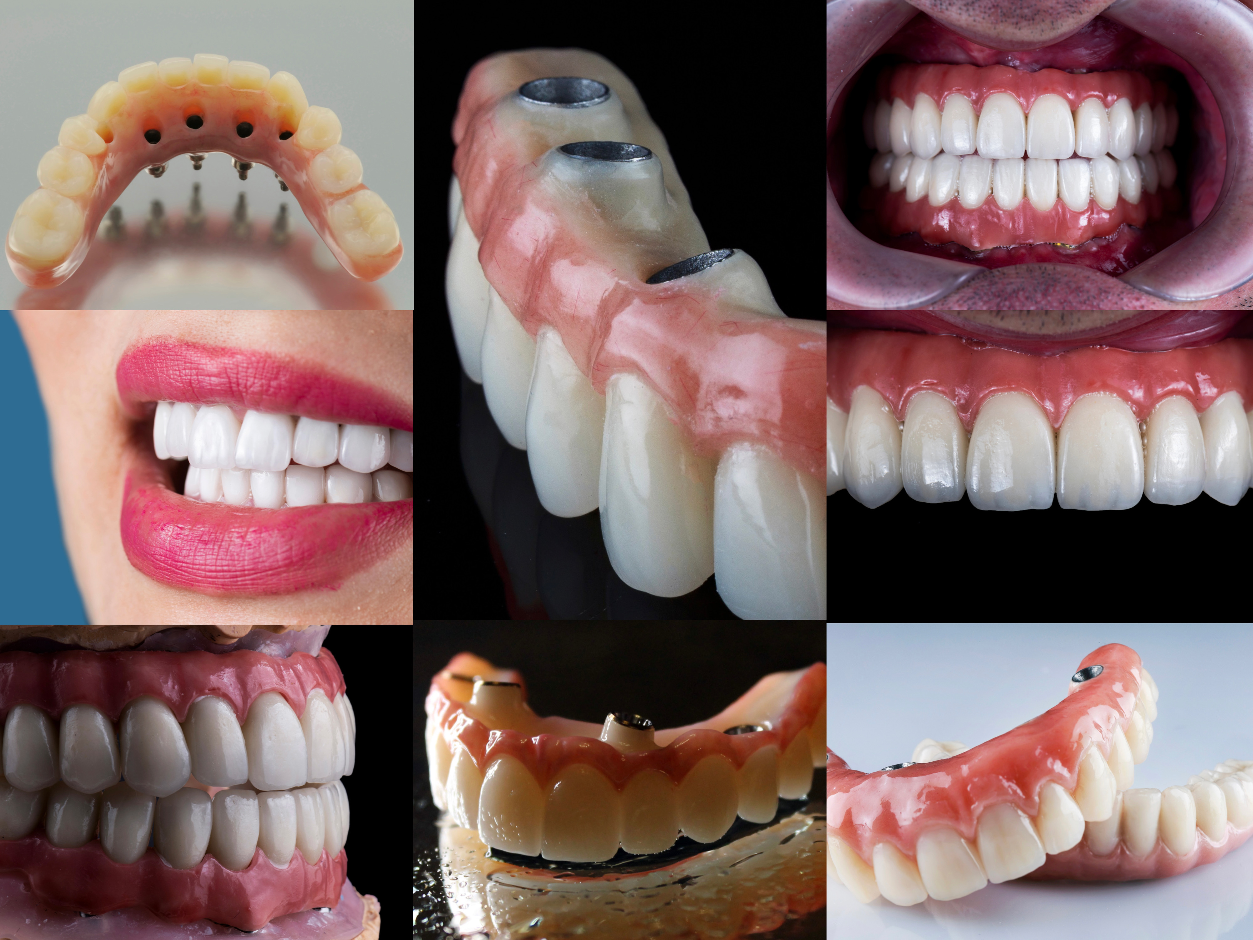 รากฟันเทียมทั้งปากแบบ All on 4 - dentalhubclinic