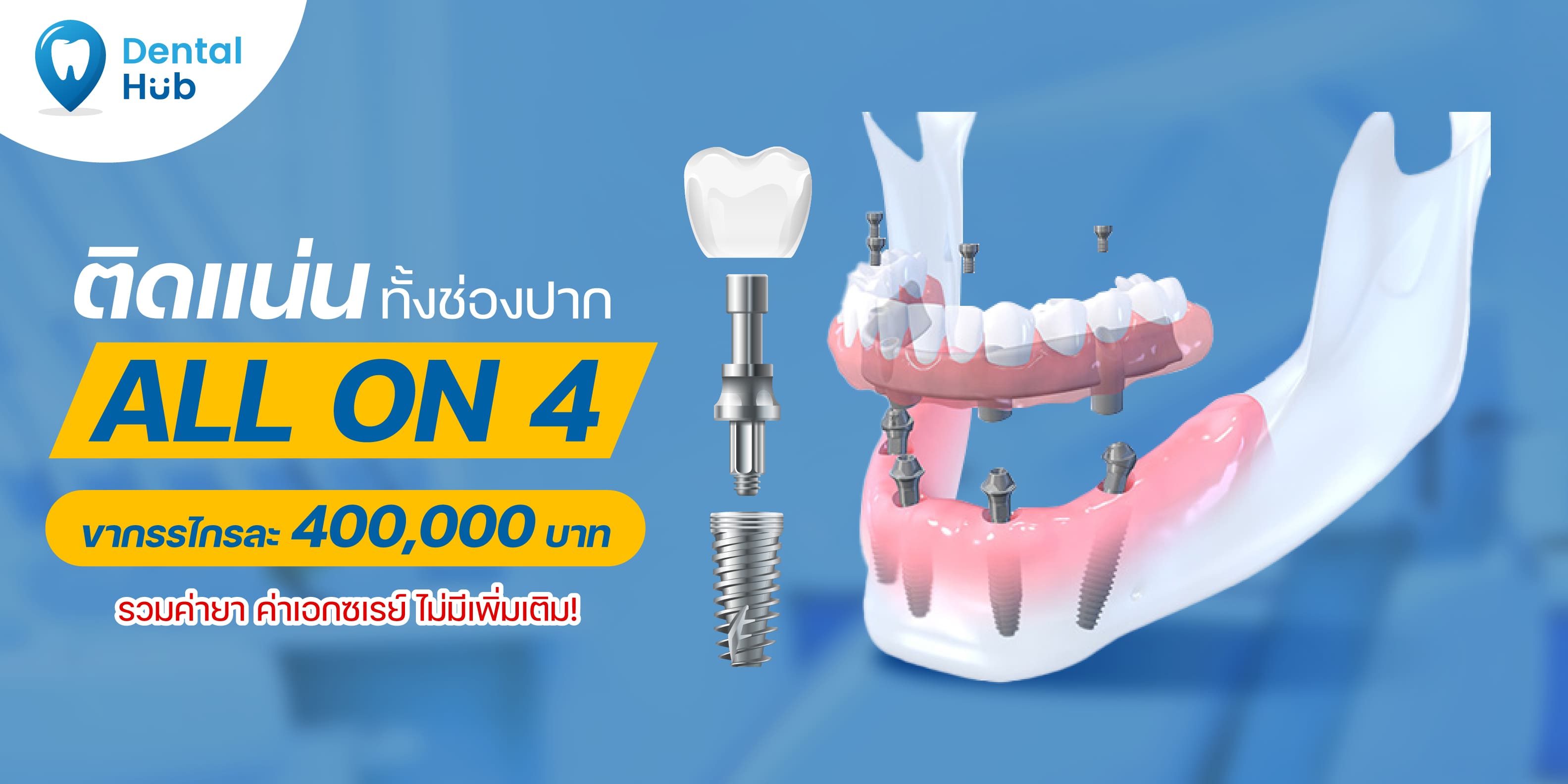 รากฟันเทียมทั้งปากแบบ All on 4 - dentalhubclinic