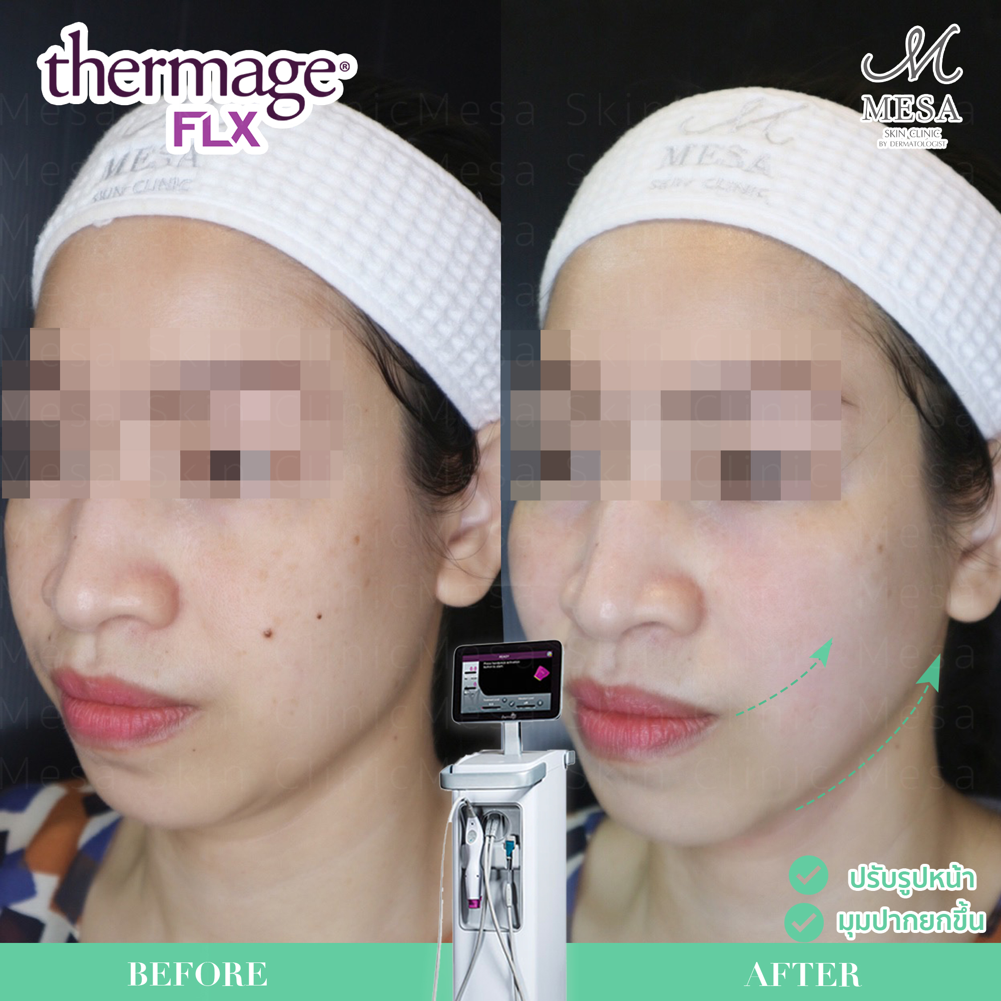 Thermage FLX - mesaskinclinic