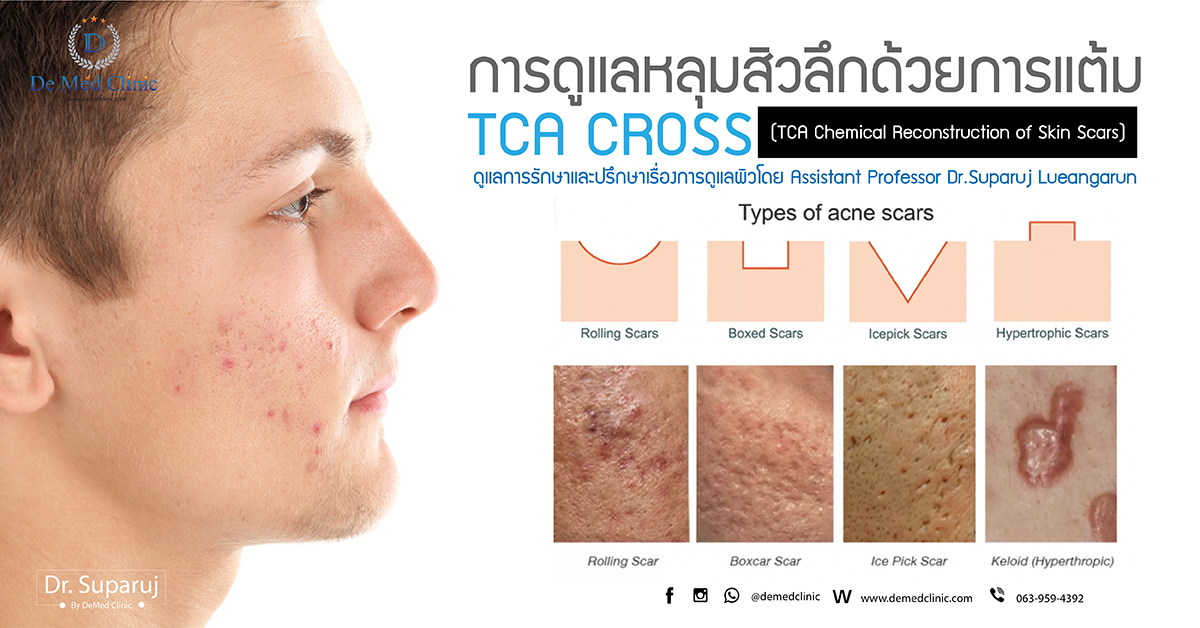 การดูแลหลุมสิวลึกด้วยการแต้ม TCA CROSS (TCA Chemical Reconstruction of ...