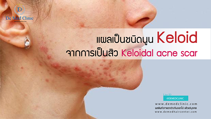 แผลเป็นชนิดนูน Keloid จากการเป็นสิว Keloidal acne scar - Demedclinic