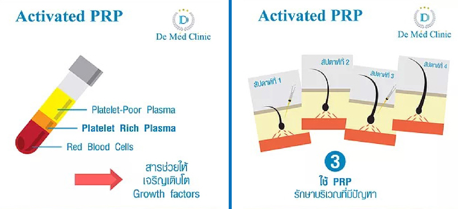 Laser Activated PRP Therapy (Platelet-Rich Plasma) เกล็ดเลือดเข้มข้น ...