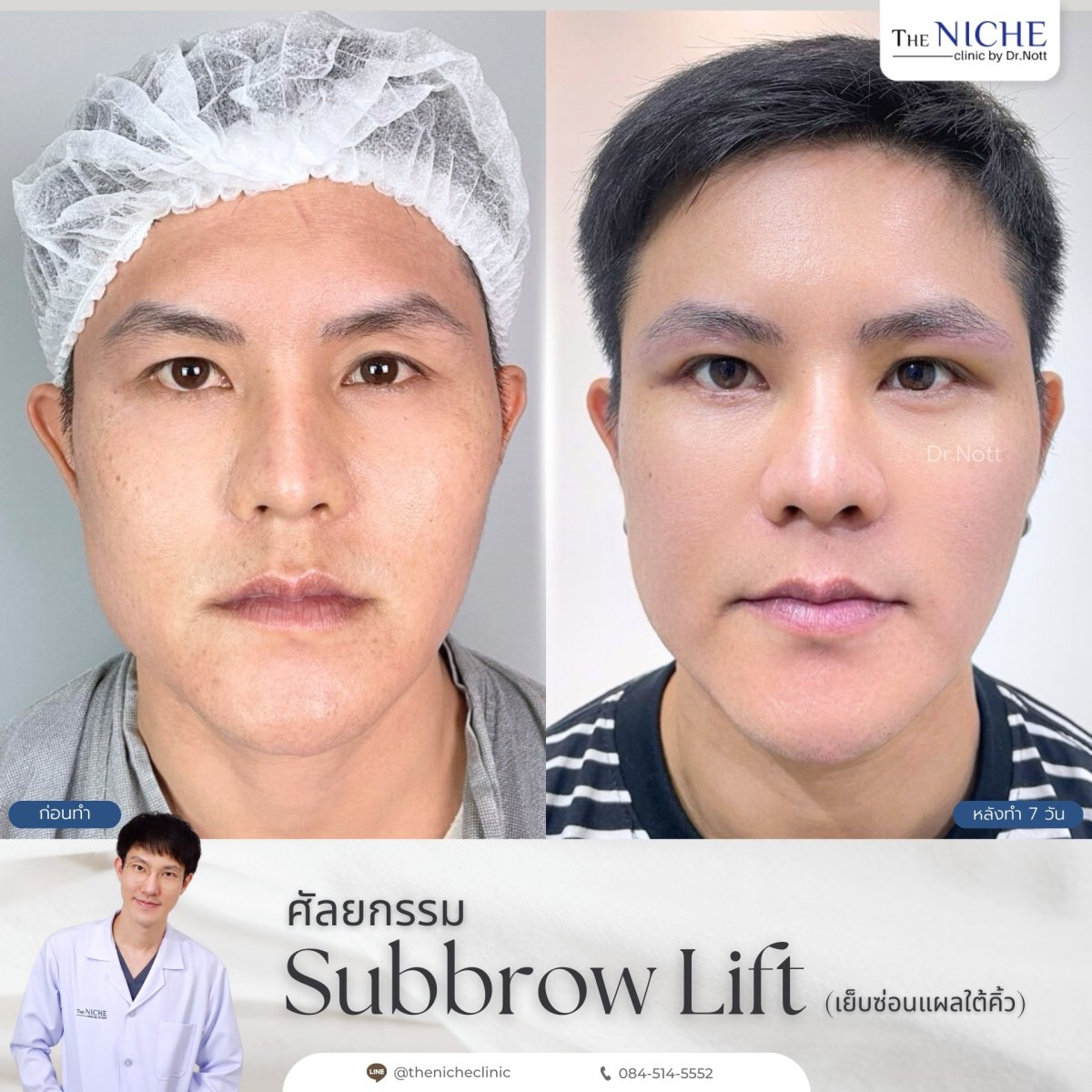 รีวิว Brow Lift (Sub-brow & Direct brow)