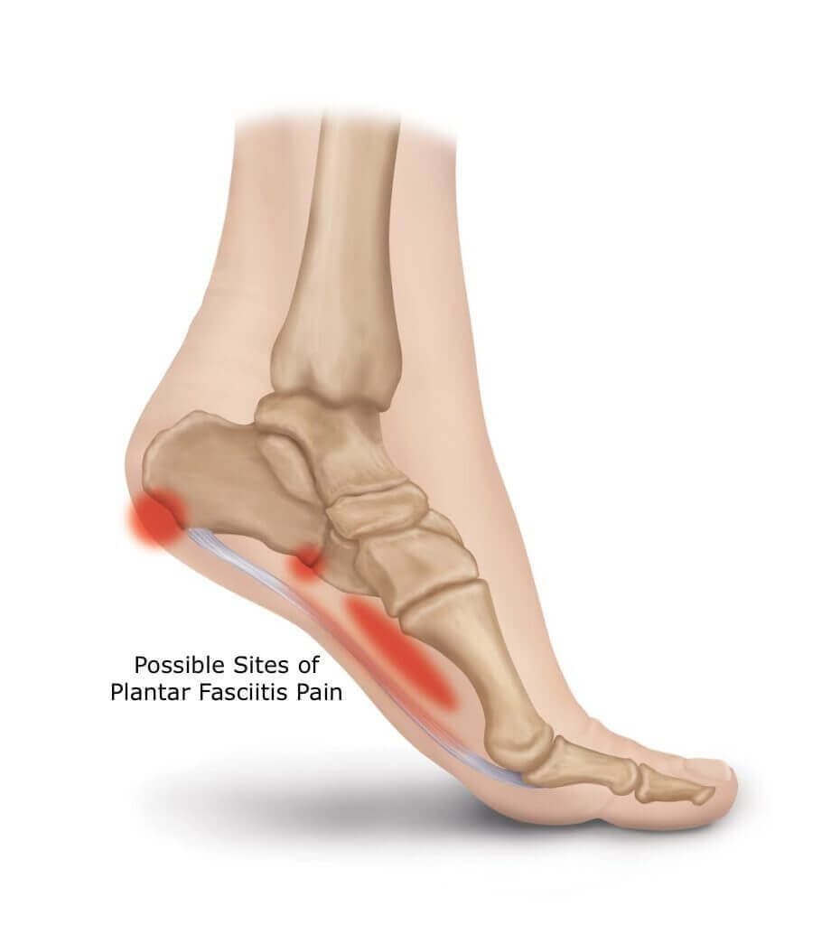 Minimally Invasive Solution for Chronic Foot Pain