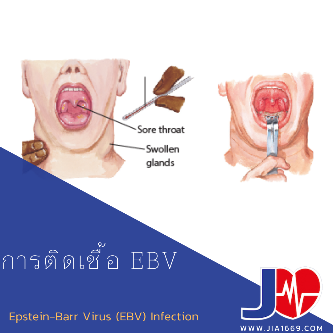 Epstein-Barr Virus (EBV) Infection - jia1669