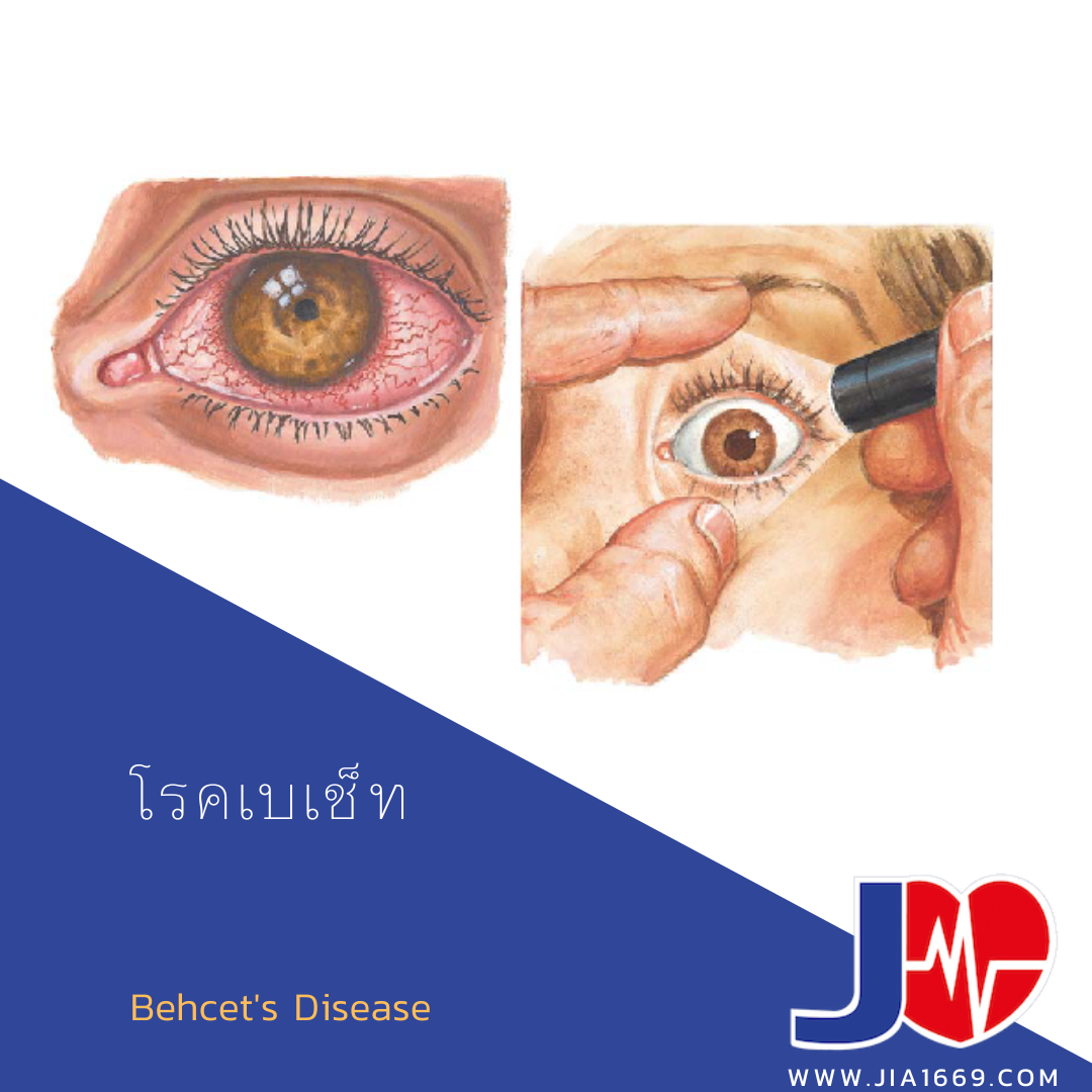 โรคเบเช็ท - jia1669