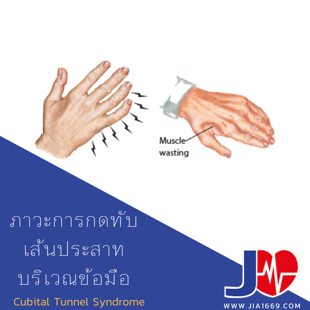 ภาวะการกดทับเส้นประสาทบริเวณข้อมือ - jia1669