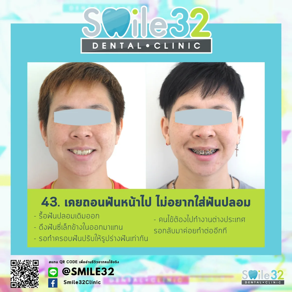 Case 43: ฟันห่าง