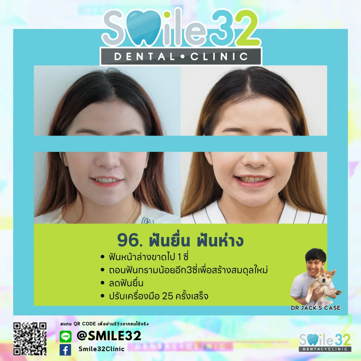 Case 96: ฟันยื่น ฟันห่าง