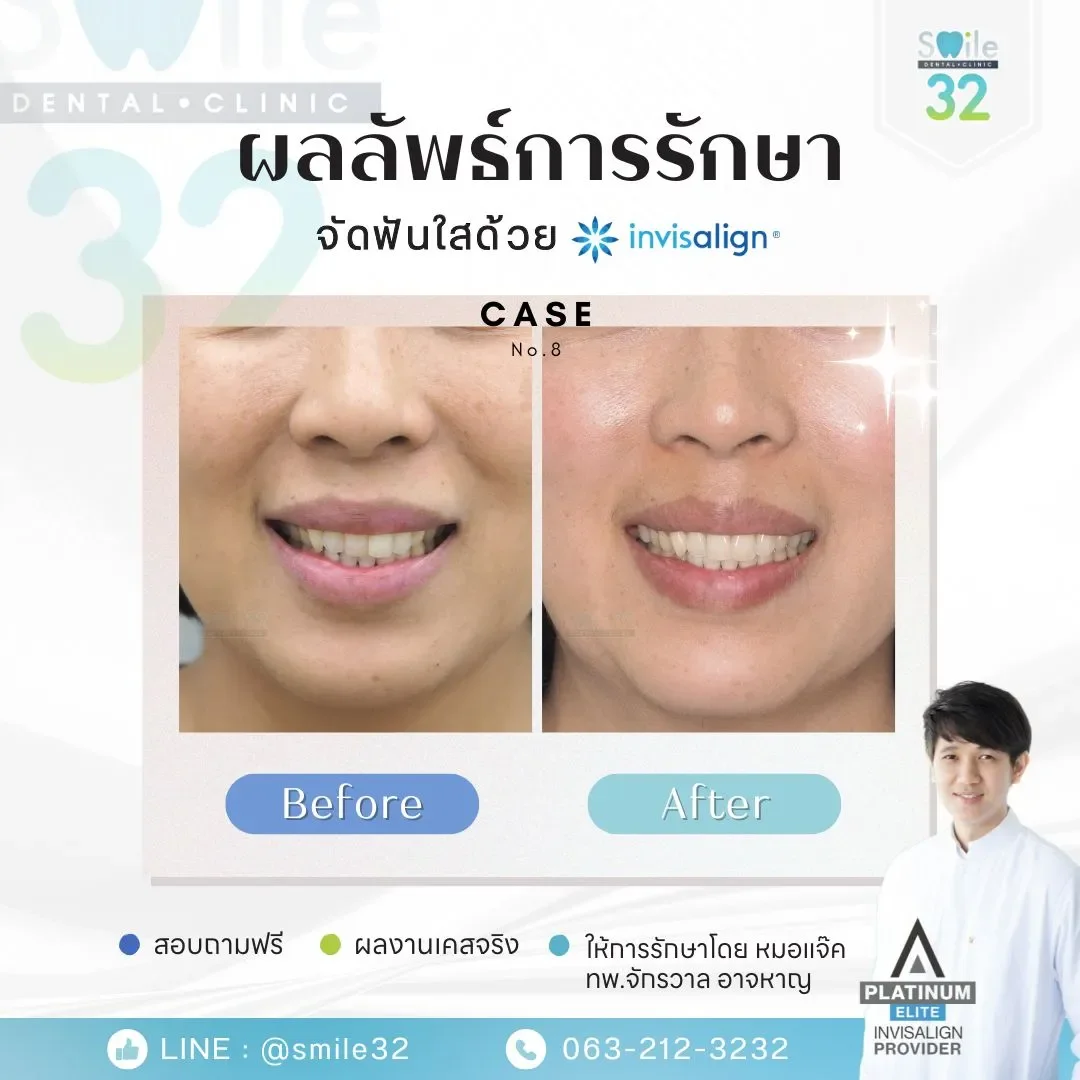Case 8: จัดฟันใส INVISALIGN