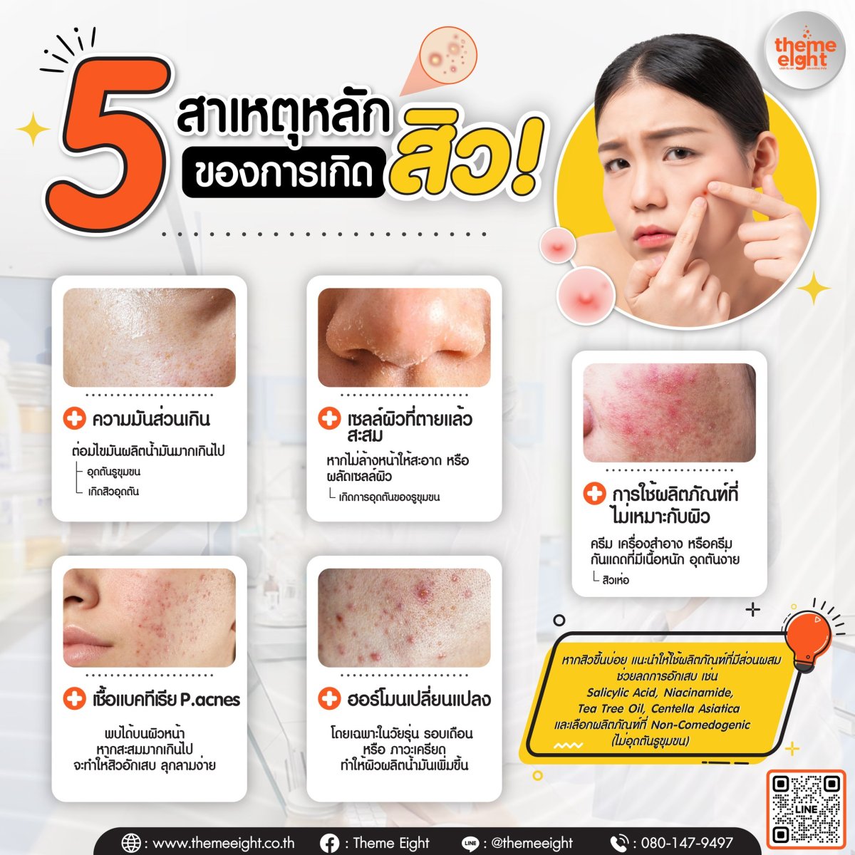 5 Main Causes of Acne!!