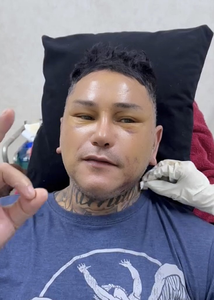 Male Facelift and Endoscopic Brow Lift Transformation