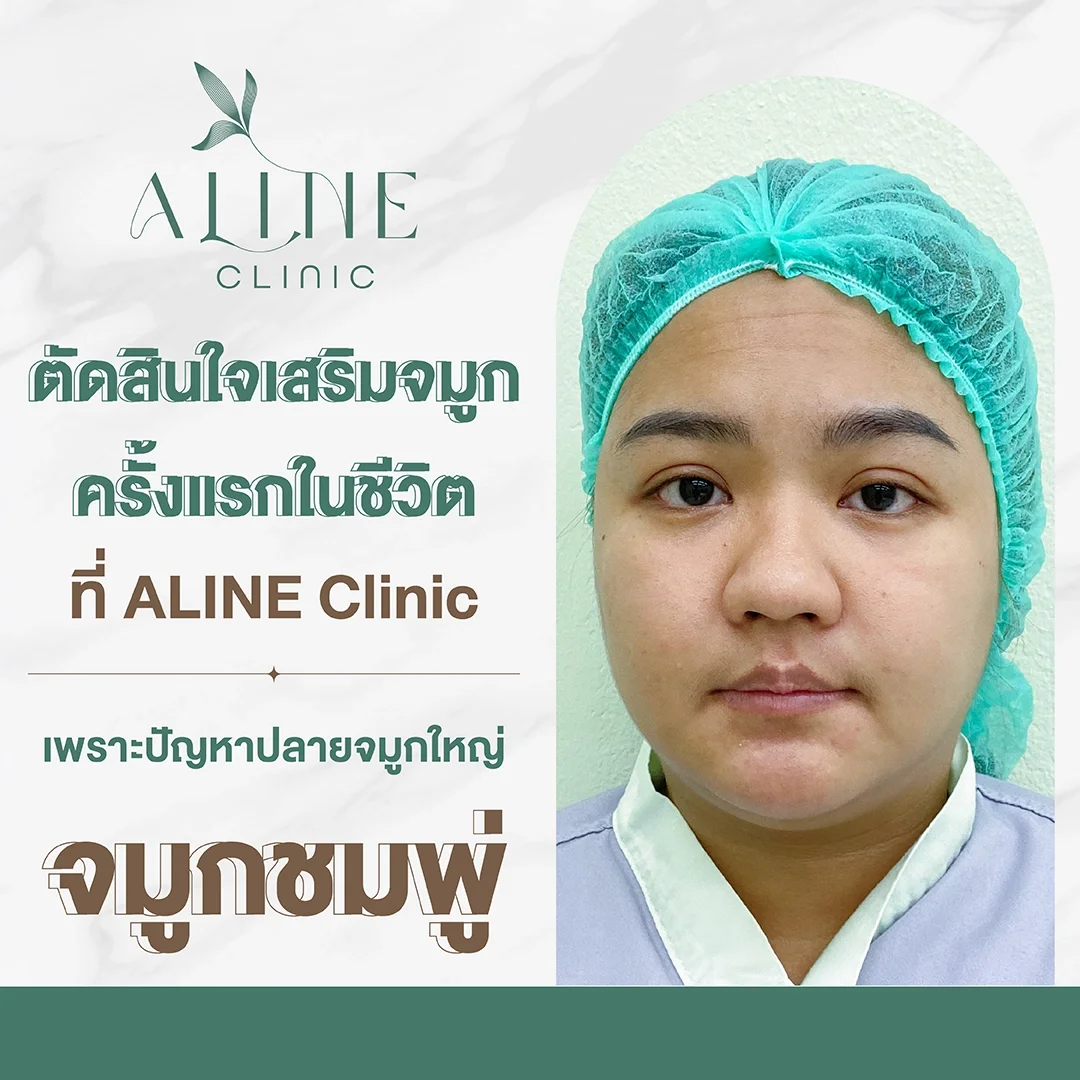 รีวิว: เสริมจมูกโอเพ่น แก้ 'จมูกชมพู่' ครั้งแรก โดยคุณหมอภูวิช ALINE Clinic