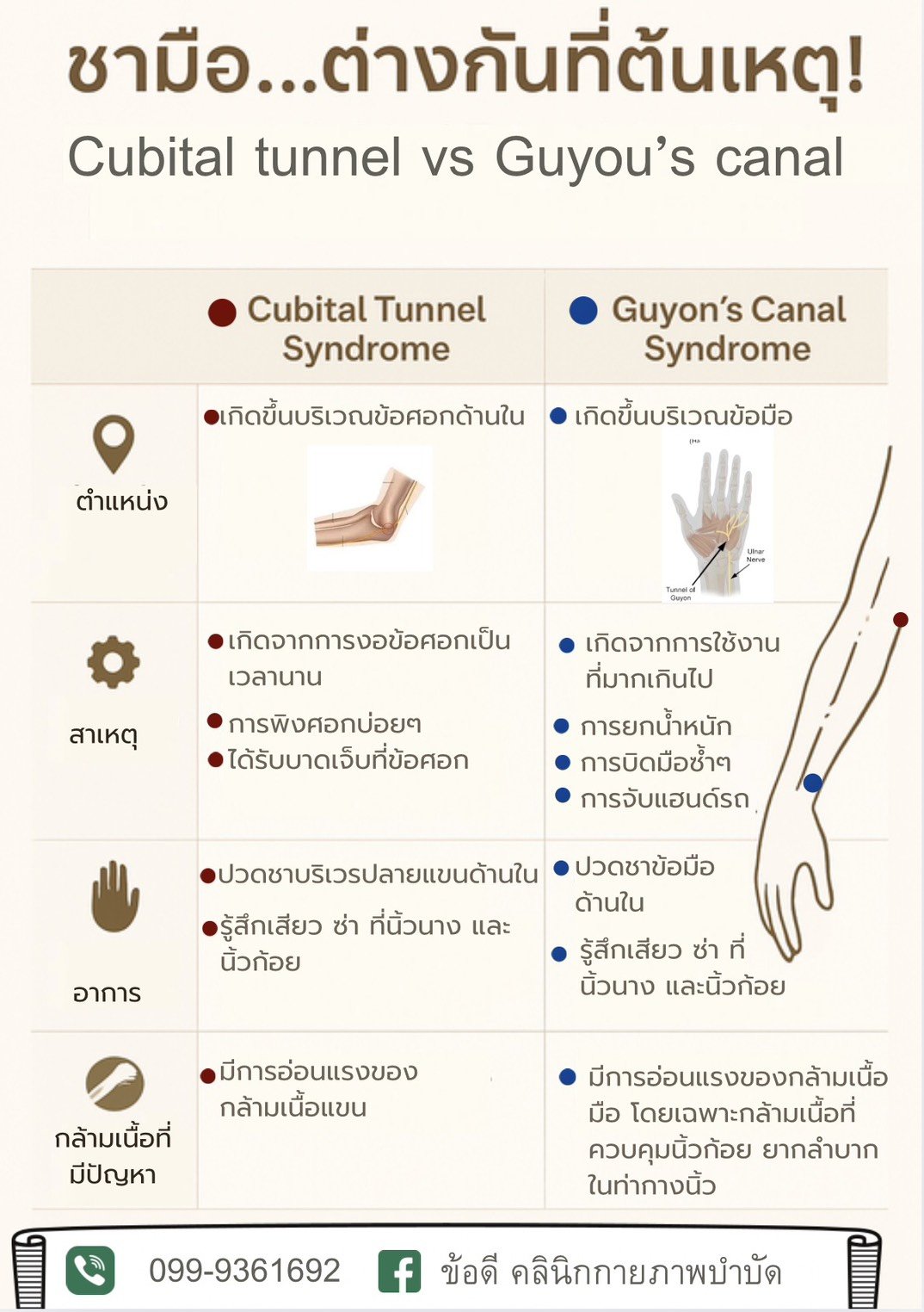 ความแตกต่างระหว่าง Cubital Tunnel และ Guyon Canal