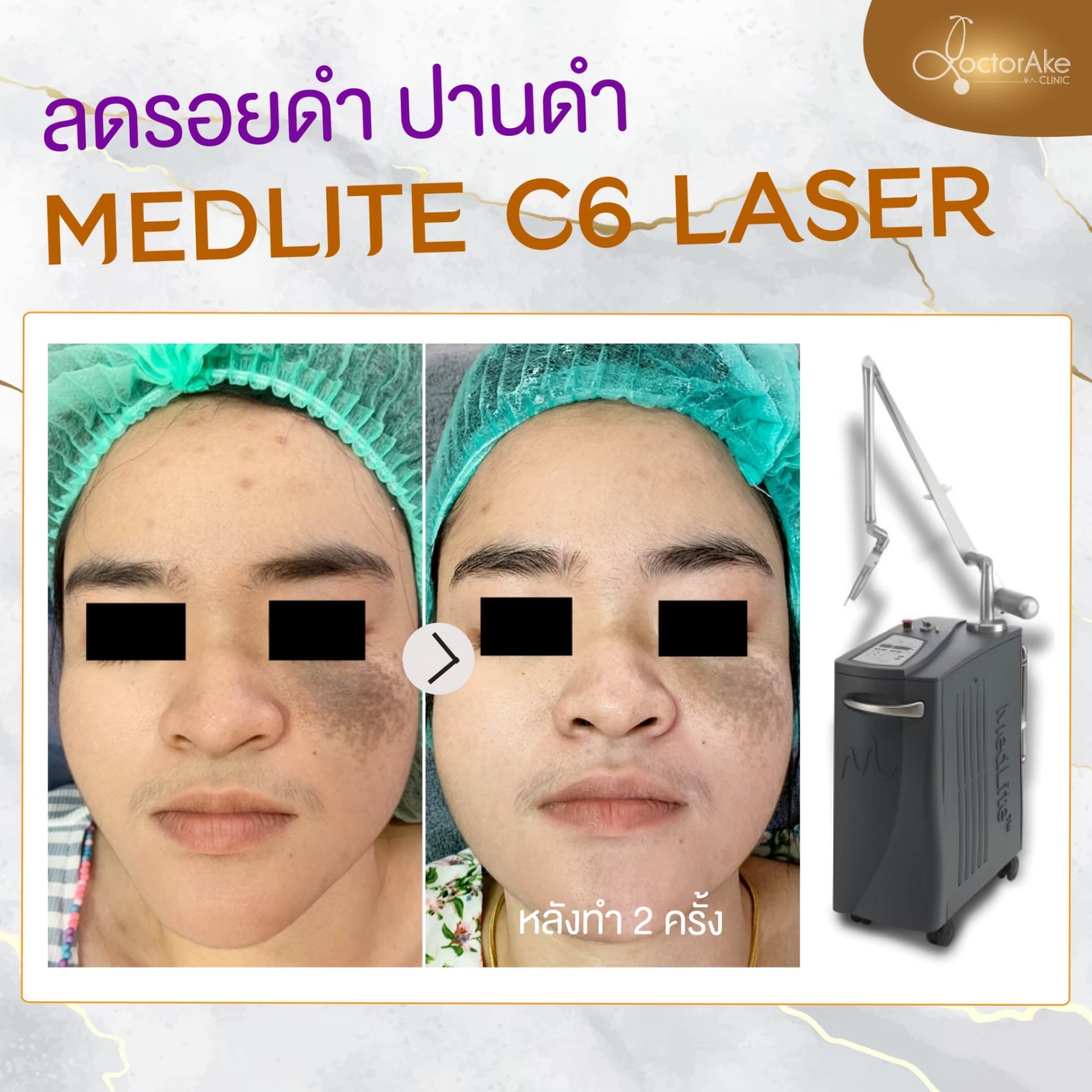 Medlite C6 Laser