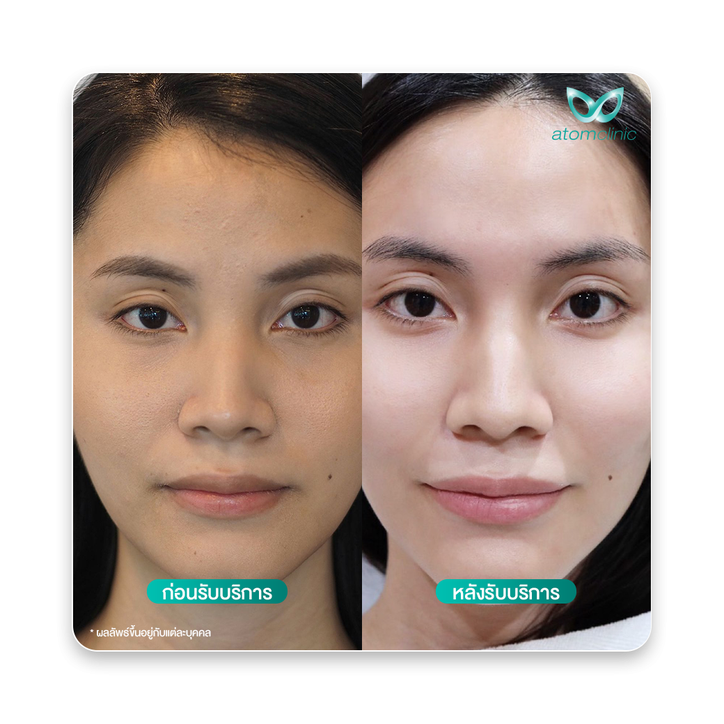 Meso Collagen เมโสคอลลาเจน - atomclinicofficial