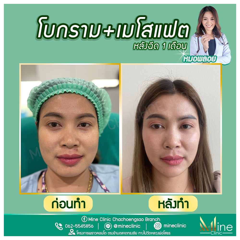 Mine Clinic คลินิกเสริมความงามและดูแลใบหน้า