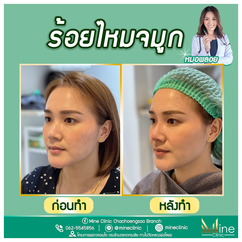 Mine Clinic คลินิกเสริมความงามและดูแลใบหน้า