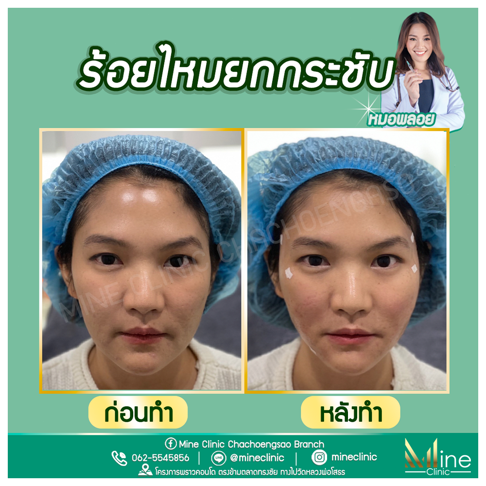Mine Clinic คลินิกเสริมความงามและดูแลใบหน้า