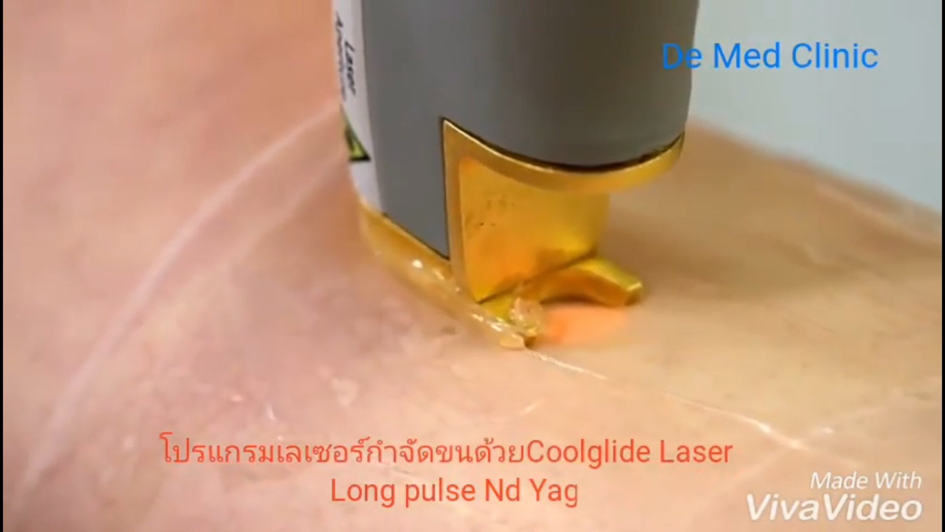 ผิวเรียบเนียน ปราศจากขนด้วย เลเซอร์กำจัดขน USA CoolGlide® CUTERA (Laser ...