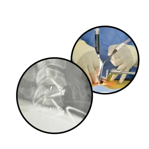 Endoscopic Acdf - Chularat International Hospital Spine specialization