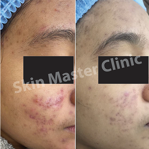 Acne clear - skinmaster-clinic