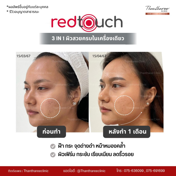 เลเซอร์ Red Touch Pro - ธัญธารีย์คลินิก กระบี่ Thantharee Clinic
