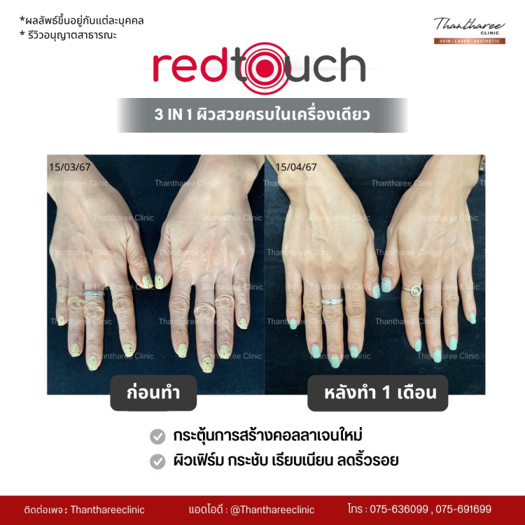 เลเซอร์ Red Touch Pro - ธัญธารีย์คลินิก กระบี่ Thantharee Clinic