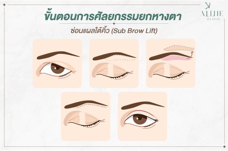 Sub Brow Lift โคราช | เทคนิคยกหางตา แก้หนังตาตก ลดอายุใบหน้า ALINE Clinic
