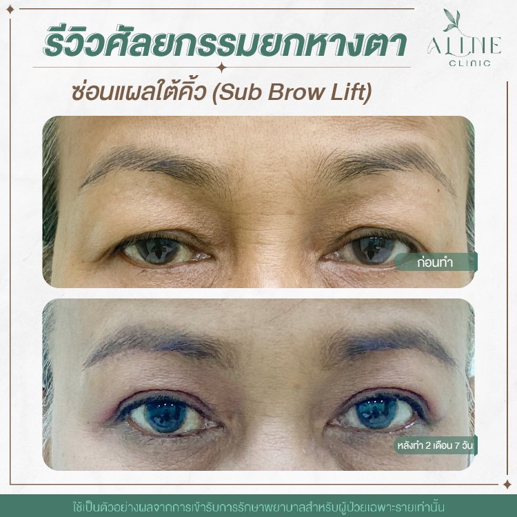 Sub Brow Lift โคราช | เทคนิคยกหางตา แก้หนังตาตก ลดอายุใบหน้า ALINE Clinic