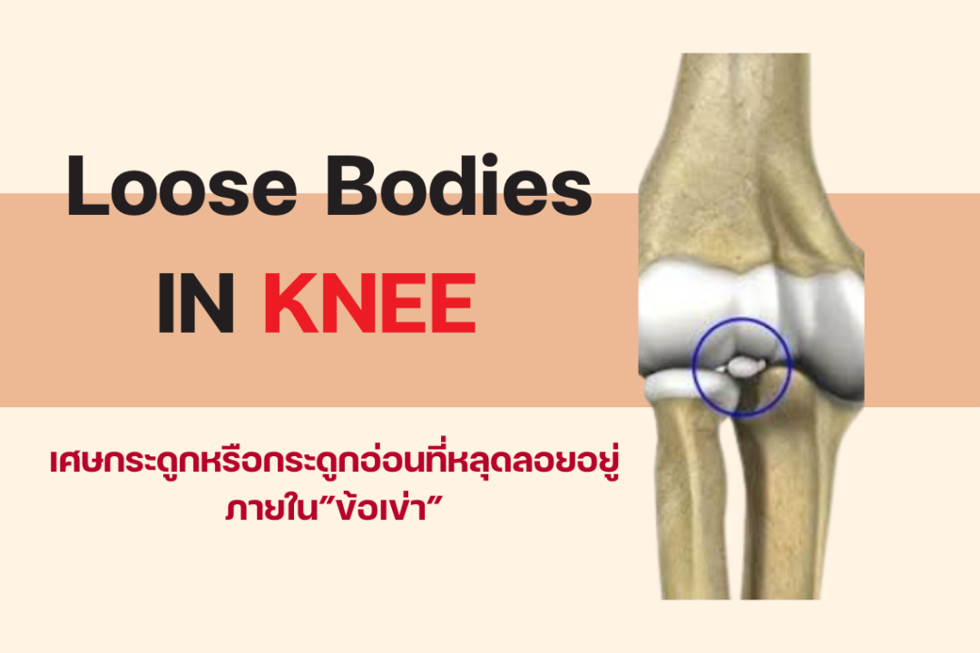 Loose Bodies in knee