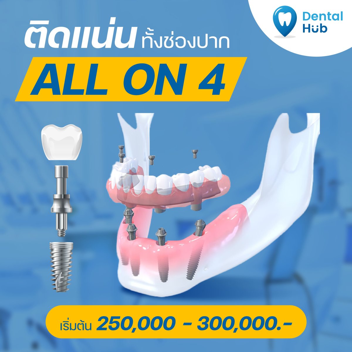 รากฟันเทียมทั้งปากแบบ All on 4 - dentalhubclinic