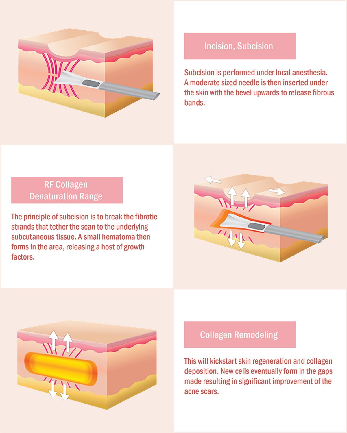 subcision หลุมสิว คืออะไร? ทำแล้วดีอย่างไร - drramita
