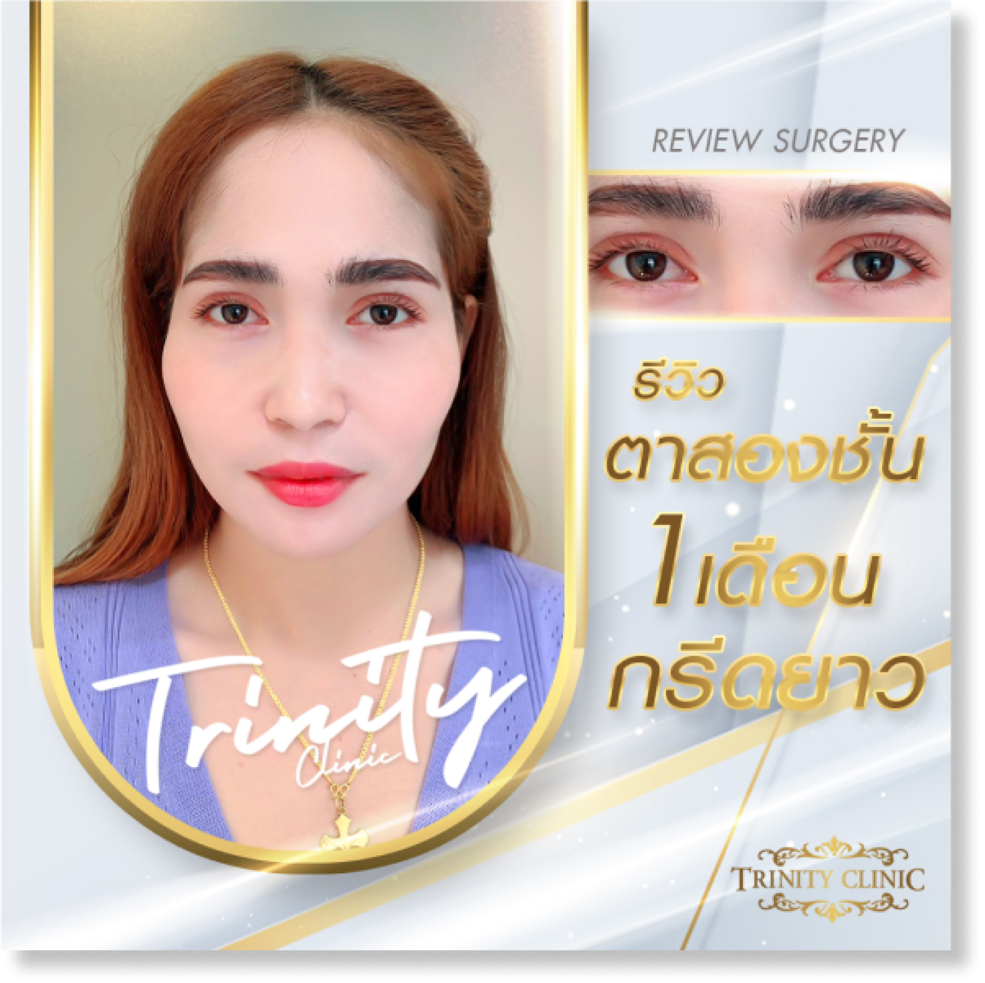ศัลยกรรมตา - Trinity Clinic ทรินิตี้ คลินิก เสริมจมูก เสริมคาง