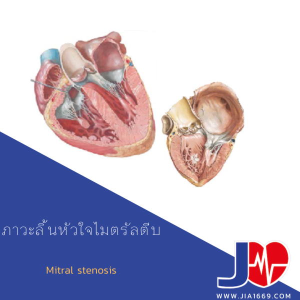 Mitral stenosis - jia1669