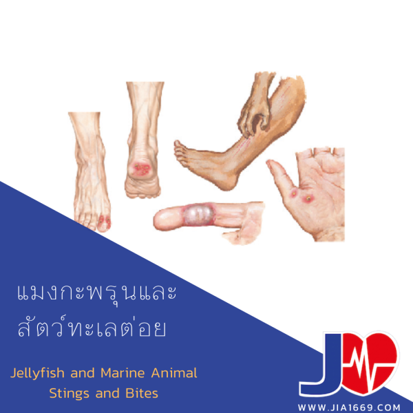 Jellyfish and Marine Animal Stings and Bites - jia1669