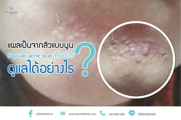 แผลเป็นจากสิวแบบนูน Papular acne scar คืออะไร ? ดูแลได้อย่างไร ...