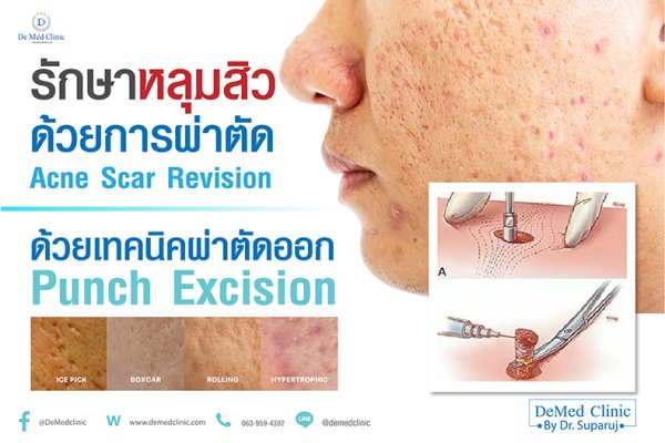 รักษาหลุมสิวด้วยการผ่าตัด Acne Scar Revision ด้วยเทคนิคผ่าตัดออก Punch ...
